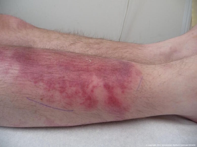 Hoe krijg je wondroos en hoe kom je er vanaf? - Gezond.be